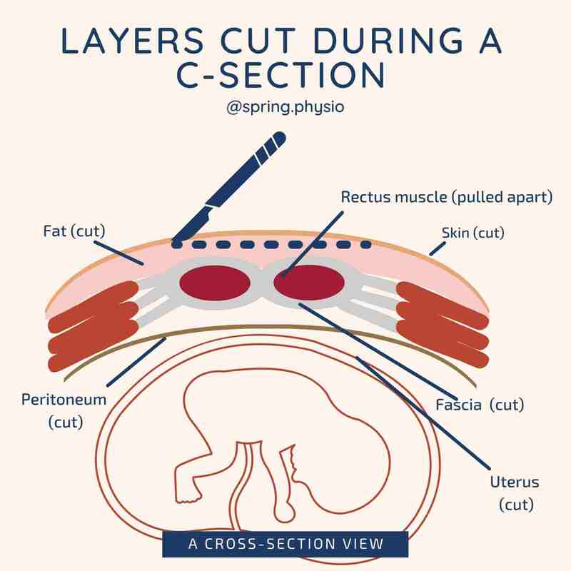C-section recovery and massage - Port Melbourne Physiotherapy & Pilates!