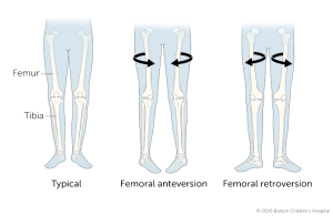 Femoral Version- Different hip shapes and why it matters - Port ...